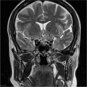 Kyste dermoïde – PinkyBone