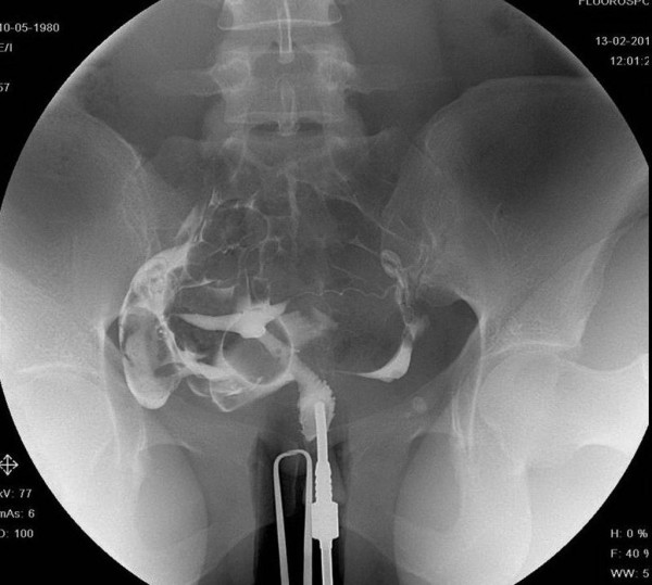 normal-hysterosalpingography-1 (4) – PinkyBone