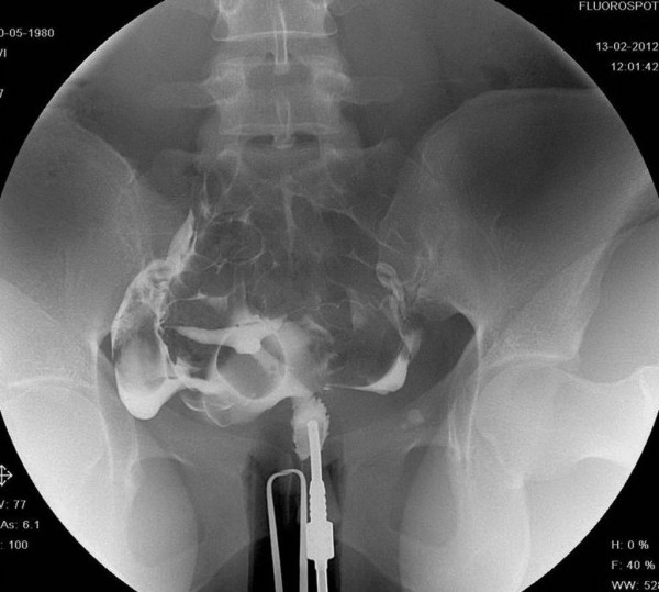 normal-hysterosalpingography-1 (5) – PinkyBone