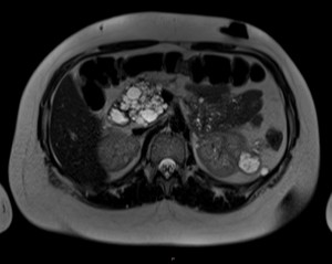 Kyste rénal – PinkyBone