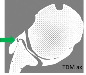 Épaule – Instabilité – PinkyBone