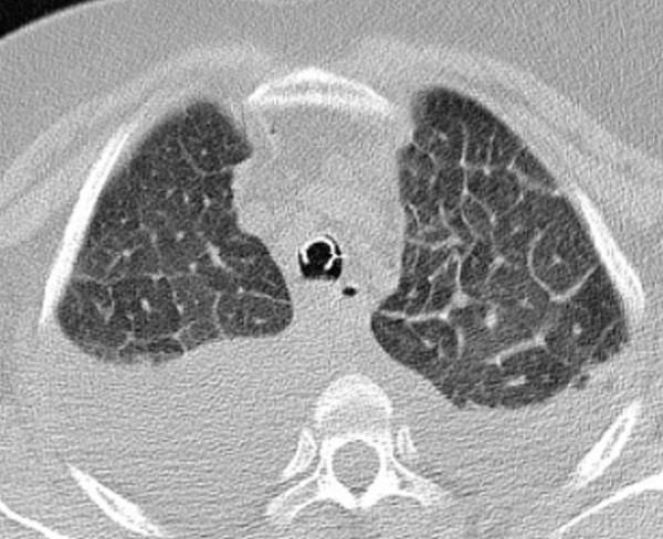 cardiogenic-pulmonary-oedema – PinkyBone