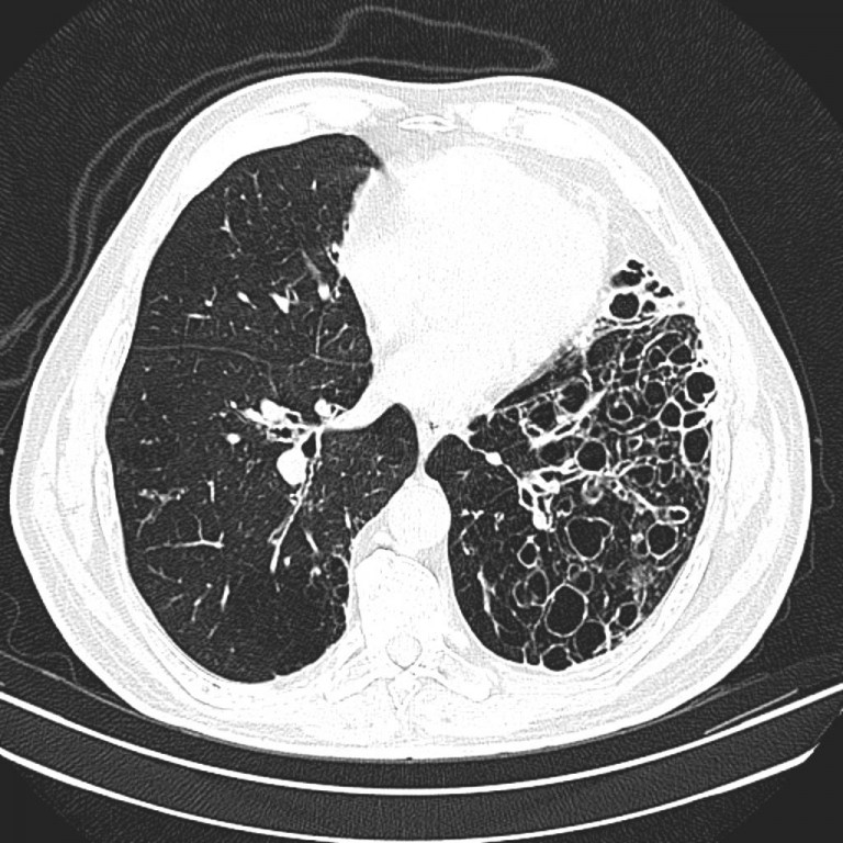 Thorax – PinkyBone