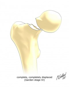Hanche – Classification de Garden – PinkyBone