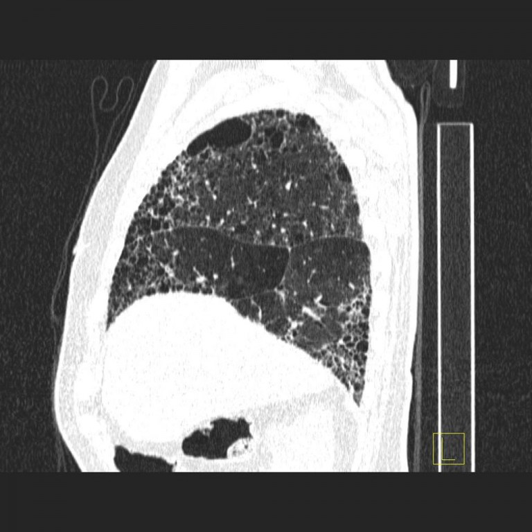 honeycombing-in-an-usual-interstitial-pneumonia-uip-pattern – PinkyBone