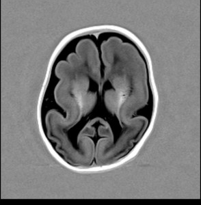 Epilepsie – PinkyBone