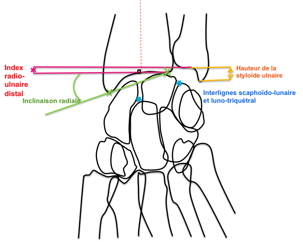 Poignet – PinkyBone