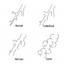 morphological-types-of-bronchiectasis – PinkyBone