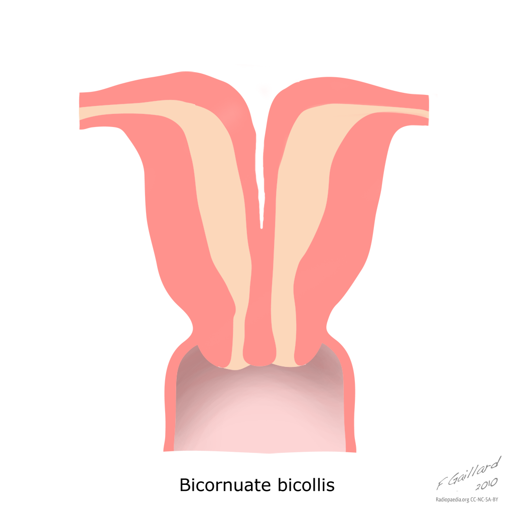 Malformations De Lutérus Pinkybone