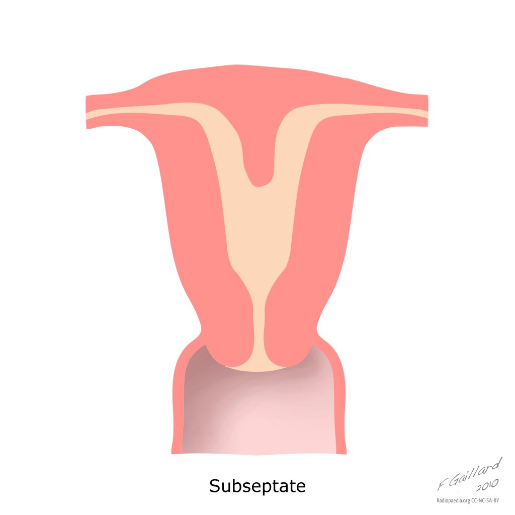 Malformations de l’utérus – PinkyBone