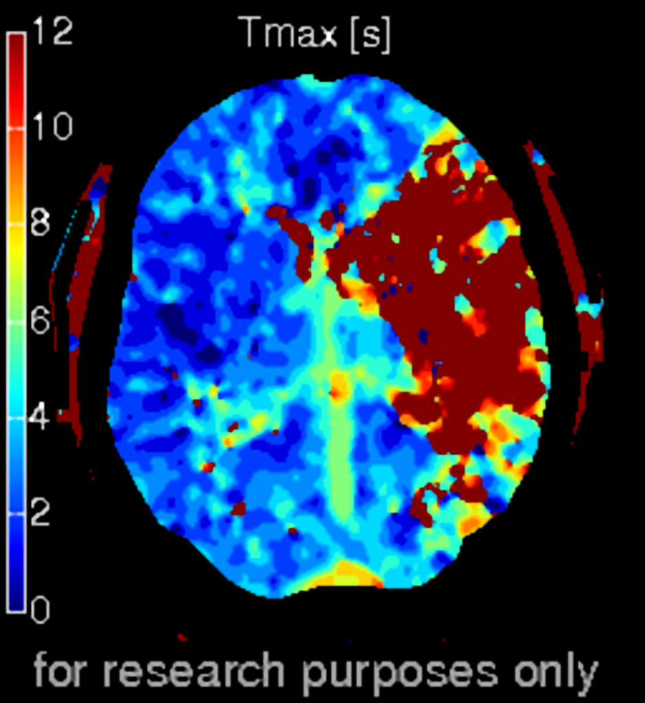 Accident ischémique constitué [ AVC ] – PinkyBone