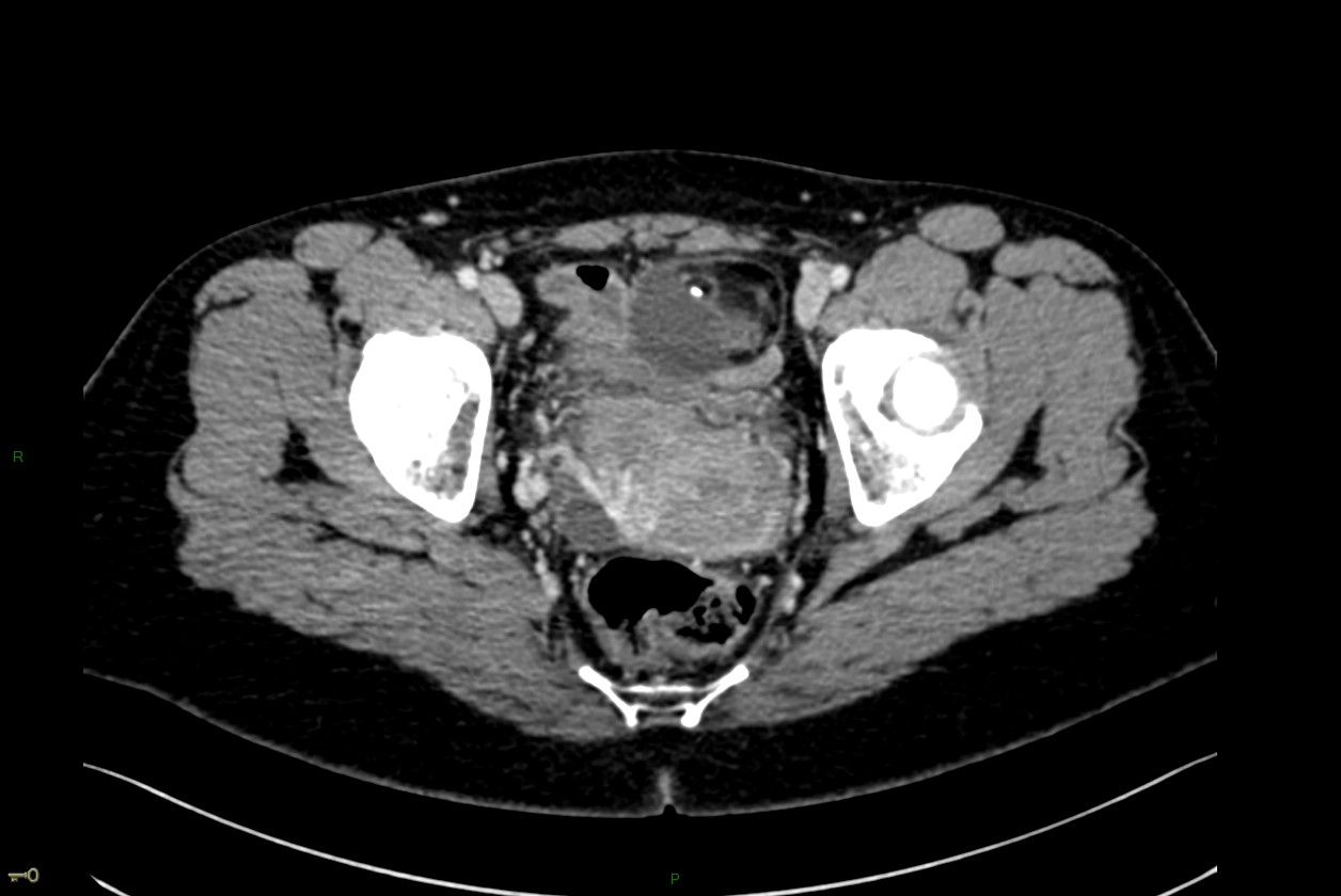 Kyste dermoïde de l’ovaire gauche – PinkyBone