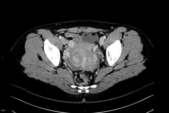 Kyste dermoïde de l’ovaire gauche – PinkyBone