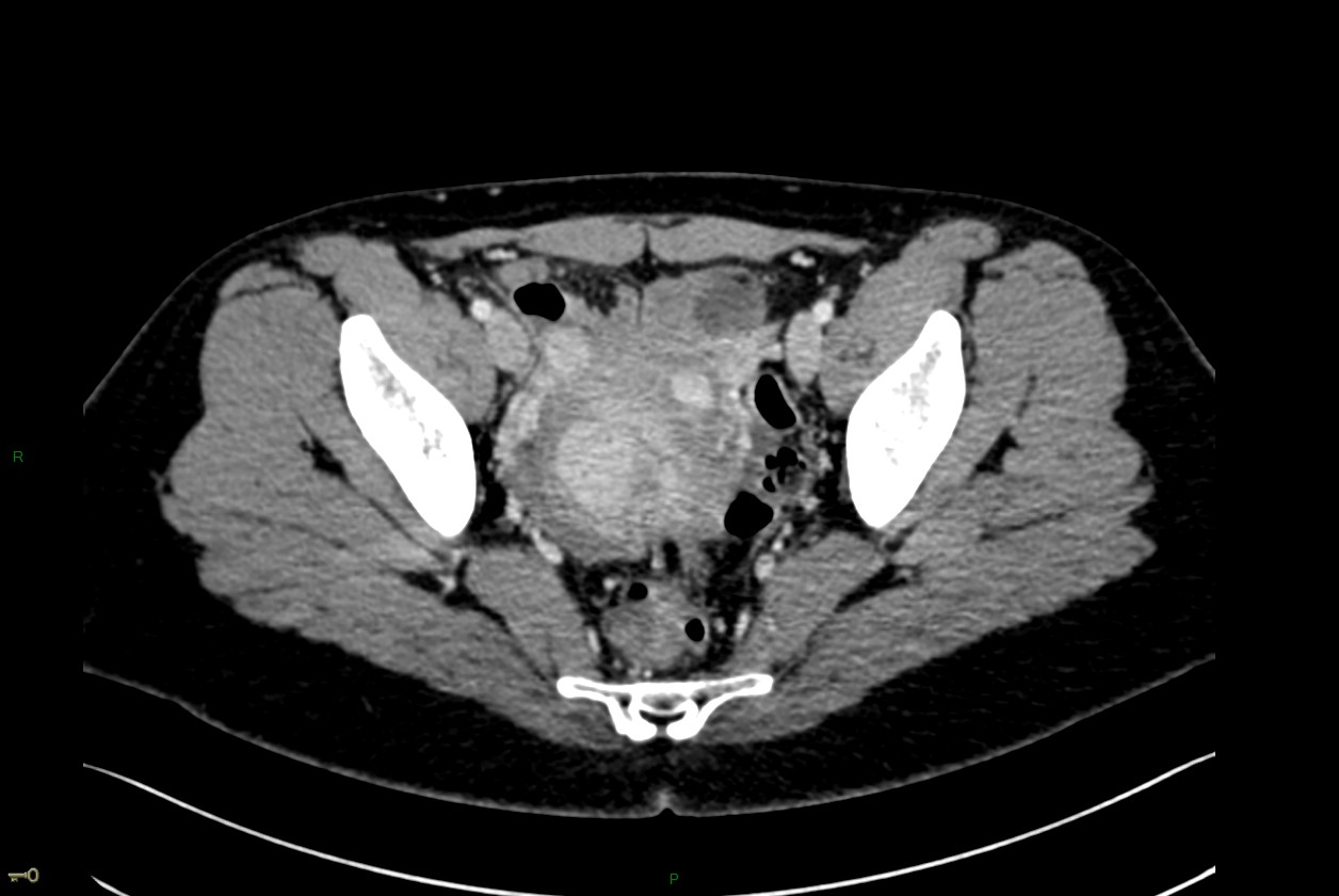 Kyste dermoïde de l’ovaire gauche – PinkyBone