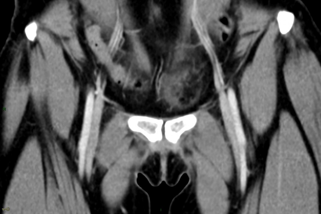 Kyste dermoïde de l’ovaire gauche – PinkyBone