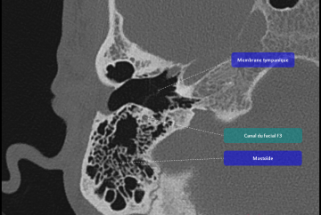 Anatomie - Rocher - PinkyBone