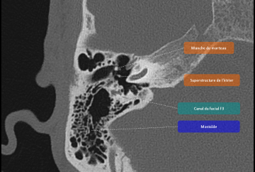 Rocher Archives - PinkyBone