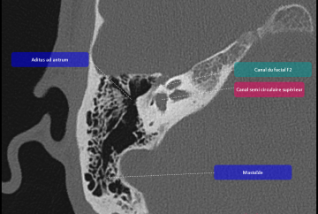 Anatomie - Rocher - PinkyBone