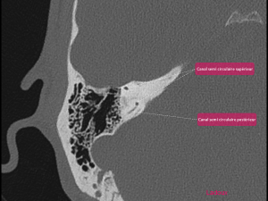 Rocher – PinkyBone