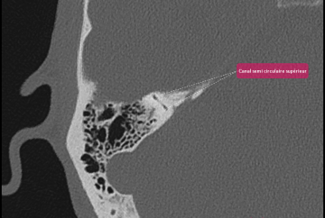 Anatomie - Rocher - PinkyBone