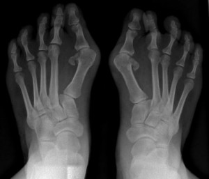 Pied – PinkyBone