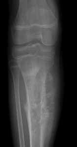 Tumeurs os – PinkyBone