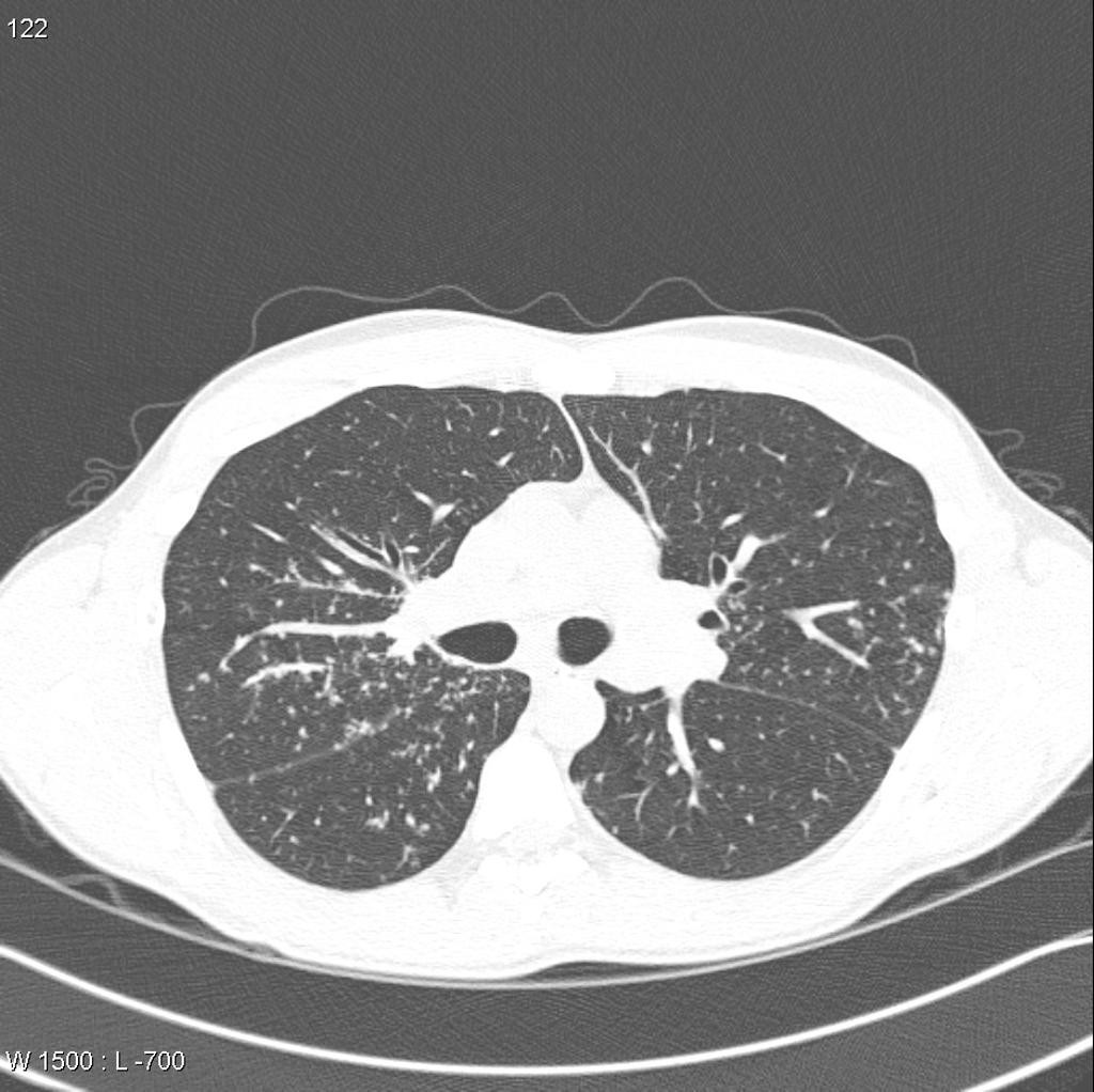 Des Nodules Sur Les Poumons _ Nodule pulmonaire : une tache sur les ...