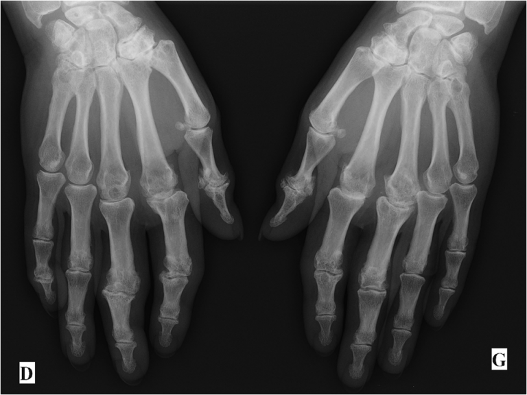 Main rhumatismale – PinkyBone