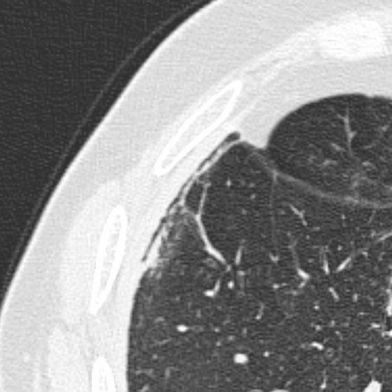 Asbestose – PinkyBone